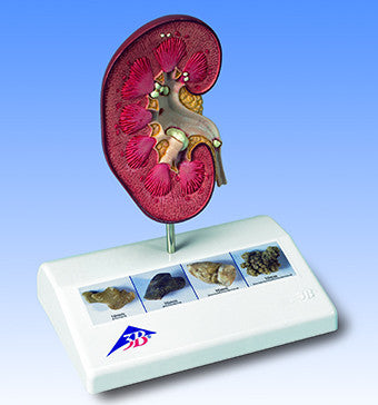 H290 Kidney Stone Model – Denoyer-Geppert Science Company